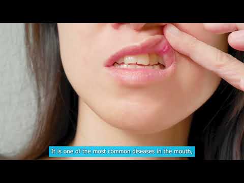 What are Canker Sores And how to treat them.
