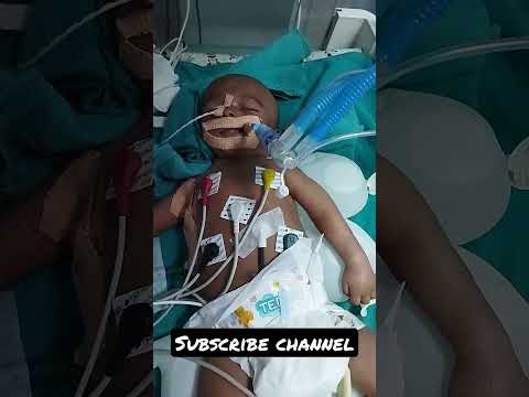 ventilater support baby#shorts#picu#youtube]