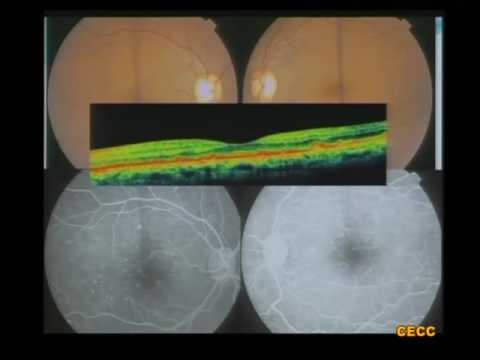 Imaging in AMD, CSR, IPFT... and Other Medical Retina Problem