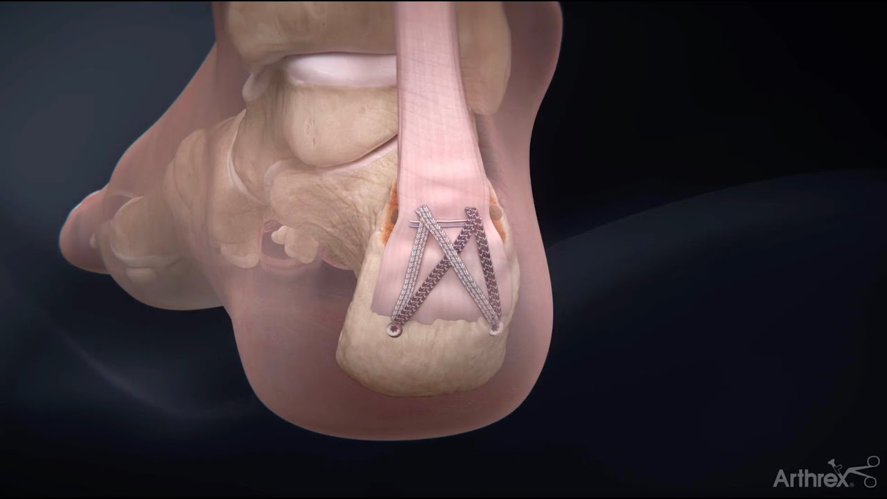 MIS Achilles SpeedBridge™ System