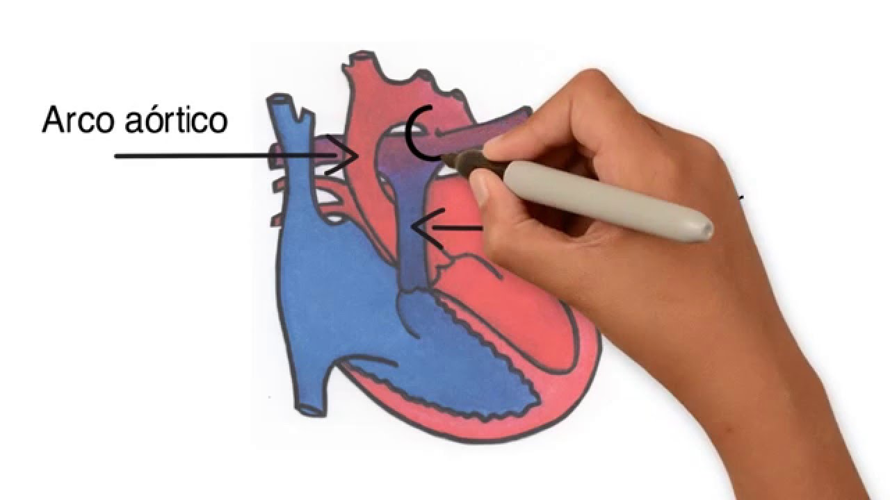 Patent ductus arteriosus