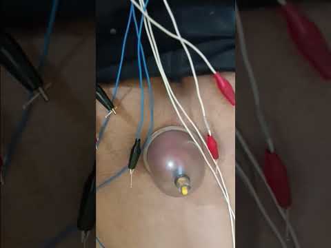 Acupuncture Treatment for slip disc #acupuncturelucknow