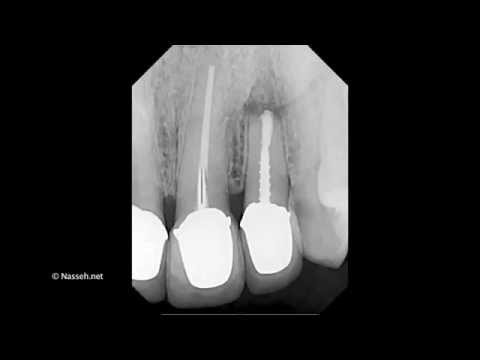 Post Op Healing EndoSequence Bioceramics : Real World Endo ...