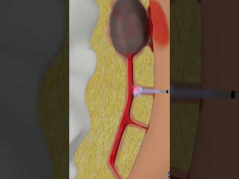 SiLaC® Laser: A Minimally Invasive Solution for Pilonidal Sinus. video credit: biolitec Youtube