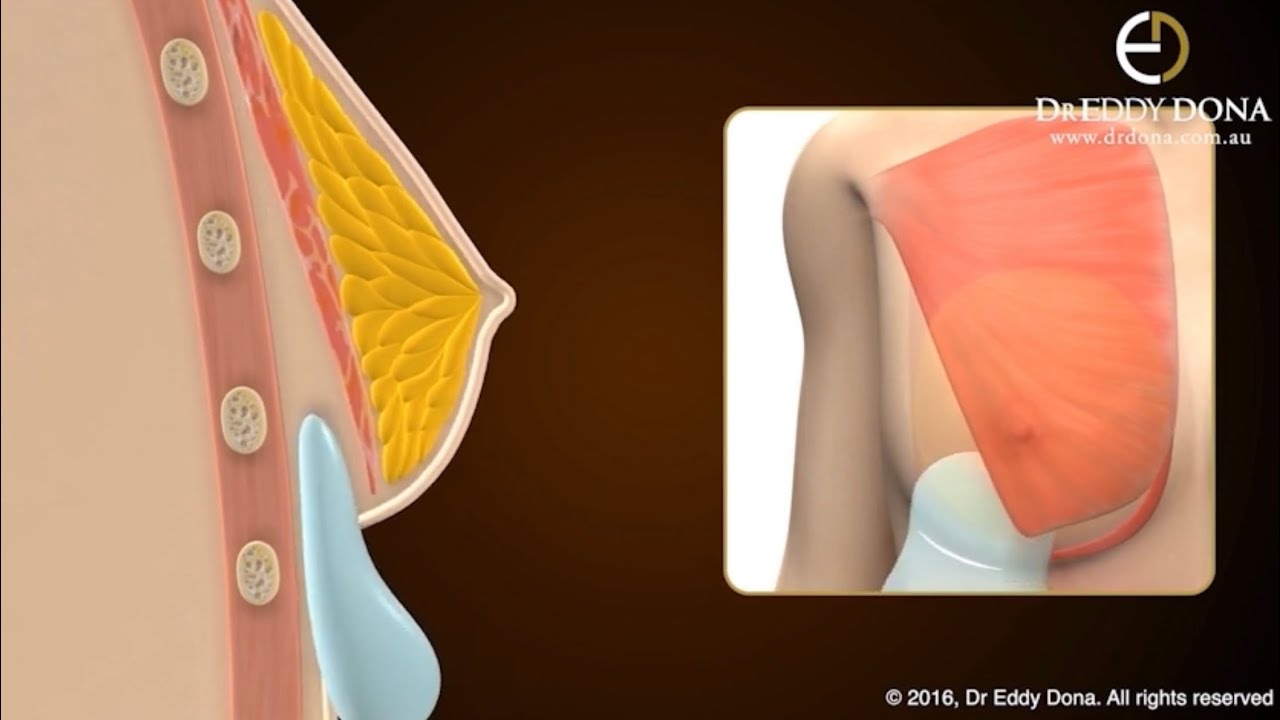 Implant Pockets - Dual Plane Type 1