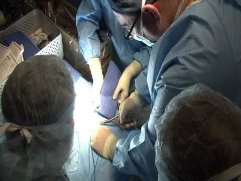 First in Michigan to Perform Robotic Heart Procedure for A-Fib