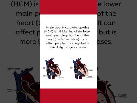 What is HCM?