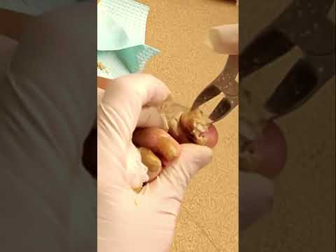 Cutting Thick Fungus Toenails! 🤯😳 #shorts