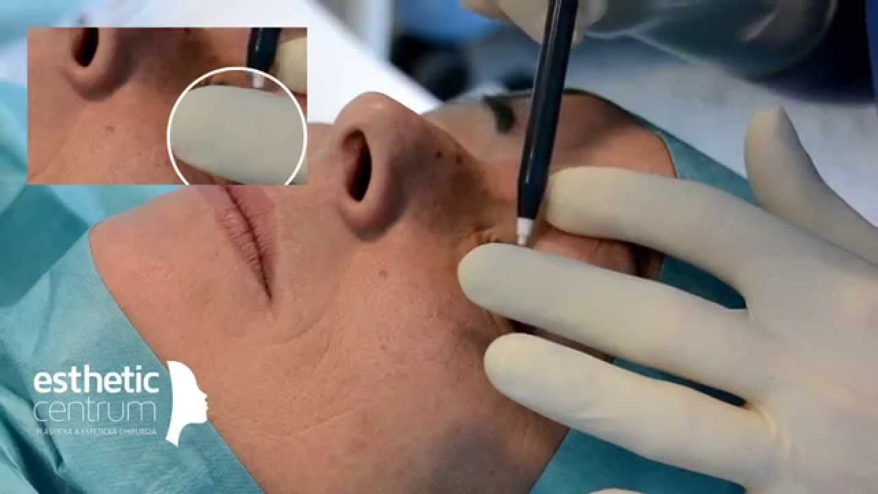 Plastická operácia viečok | Zlavomat.sk