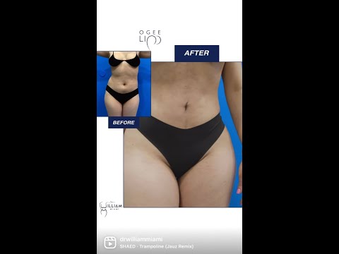 BBL with Ogee Lipo