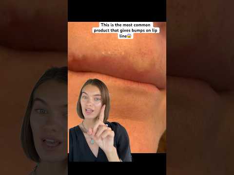 Have bumps on lip line? This is probably why🥹😳#skincare #acne #skincareforacne #acnetreatment