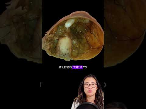 Mature Ovarian Teratoma #radiology #medicalstudent #radiographer #medicine
