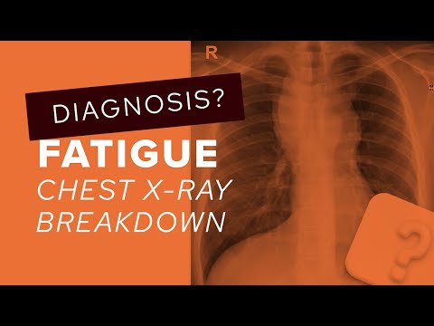 Chest X-Ray breakdown: dealing with an abnormal mediastinal contour