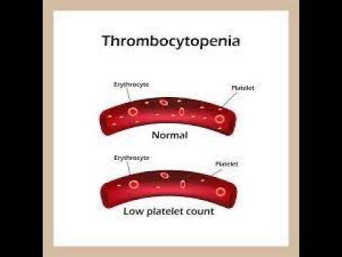 Thrombocytopenia Explained: Definition, Causes, Symptoms, Diagnosis & Treatment