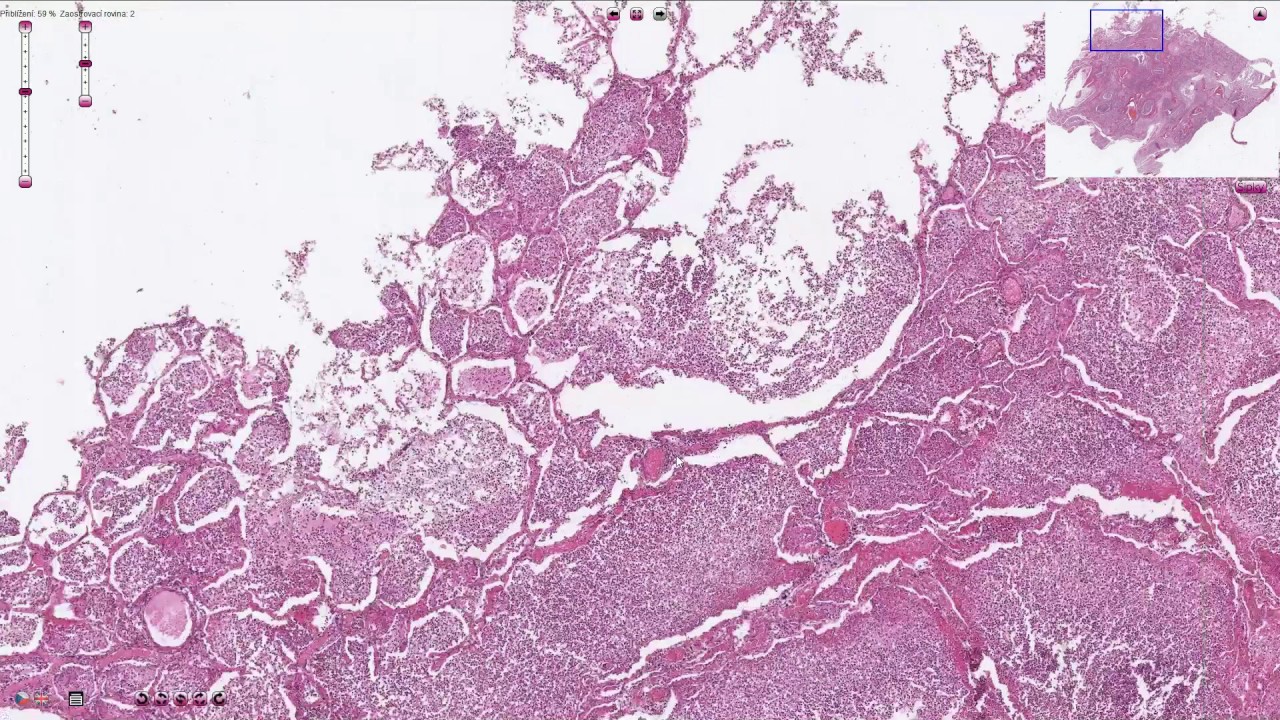 Histopathology - Bronchopneumonia
