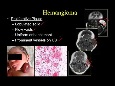 Simplified Approach to Craniofacial Vascular Malformations