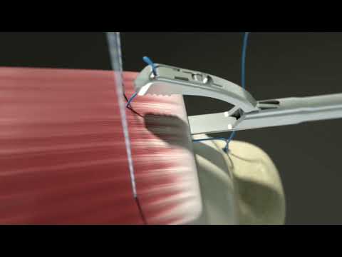 Rotator cuff repair animation with Iconix and ReelX
