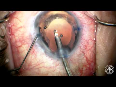 Traumatic Cataract and Aniridia Repair with Artificial Iris