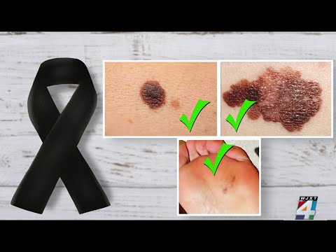 What is Melanoma?