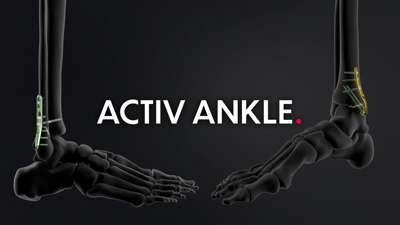 Activ Ankle - Management of ankle fractures & osteotomies