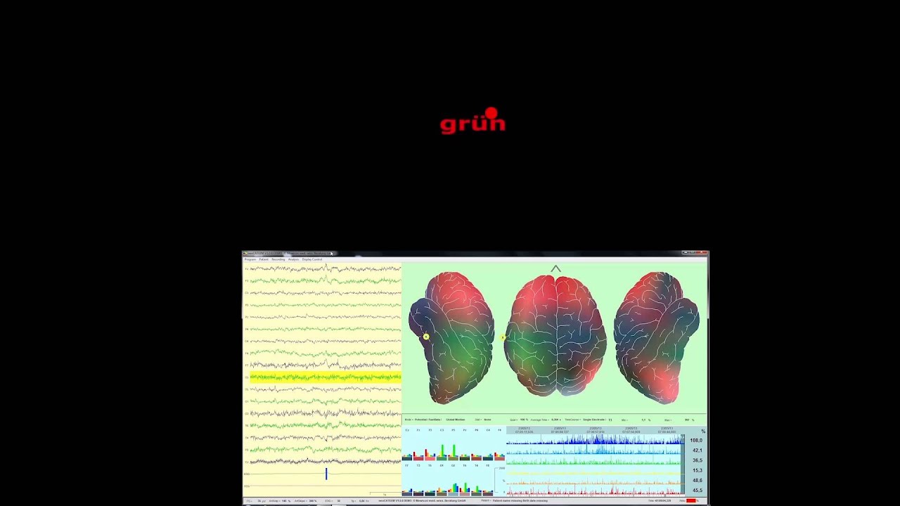 Neurocode Tracking (Quantitative EEG) and Eye Tracking Stroop Test