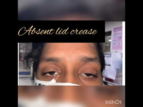 congenital ptosis important signs