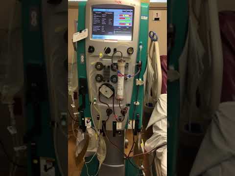 Plasmapheresis for MS