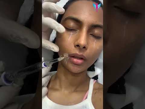 Dermal Fillers | Contoured Face | Profile Balancing | Face Contouring