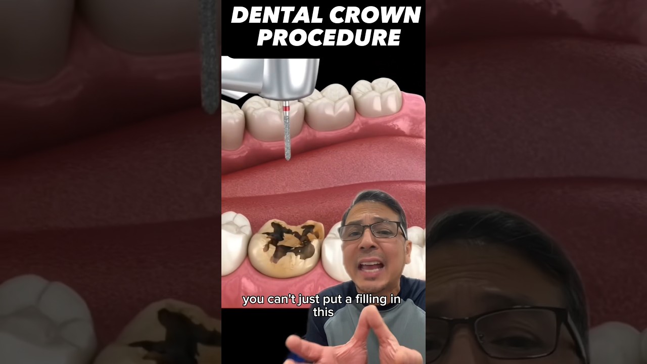 Restoring Worn Out Teeth with a Dental Crown (EXPLAINED) | View Mobile Dental