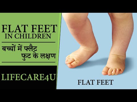Flat feet in children hindi | बच्चों में फ्लैट फुट के लक्षण | Causes, Effects, and Solutions