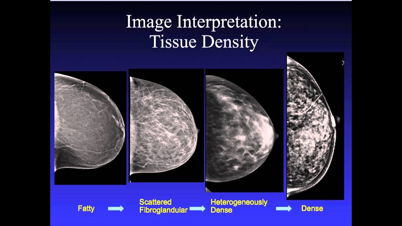 Introduction to Mammography