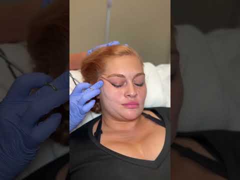 FACELIFT LIKE RESULTS IN MINUTES WITH PDO THREADS #youtubeshorts #pdothreadlift