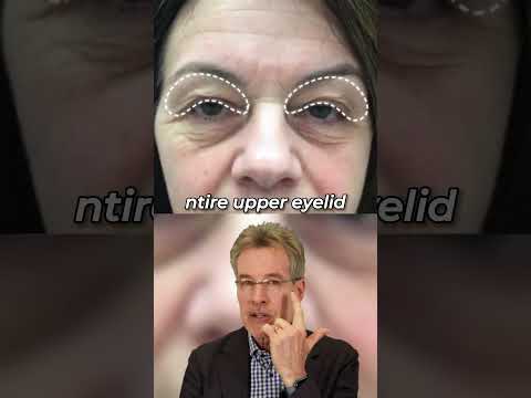 Brow Lift VS Blepharoplasty | #browlift #eyelift #eyes