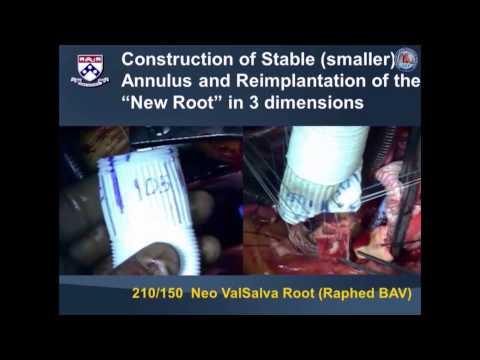 Valve-sparing aortic root reimplantation and cusp repair in bicuspid aortic valve