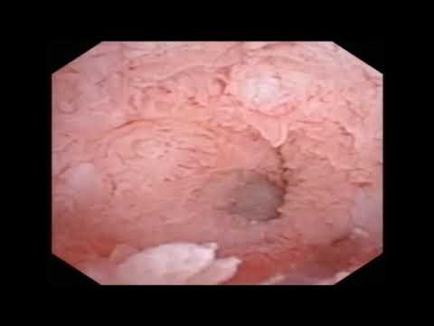 Asvide: Normal sphincter of Oddi