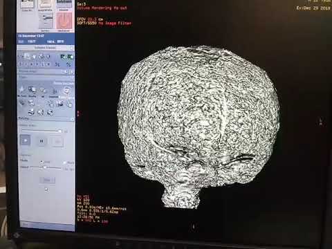Brain Parenchyma