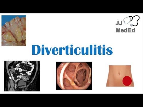 Diverticulitis: Risk Factors (ex. Low Fiber Diets), Symptoms, Diagnosis, Treatment and Complications