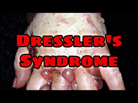 Dressler's syndrome|Causes|Symptoms Diagnosis|Part 1