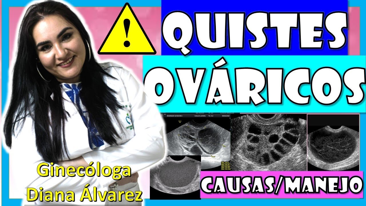 Everything about ovarian cysts: causes and treatment, by gynecologist Diana Alvarez