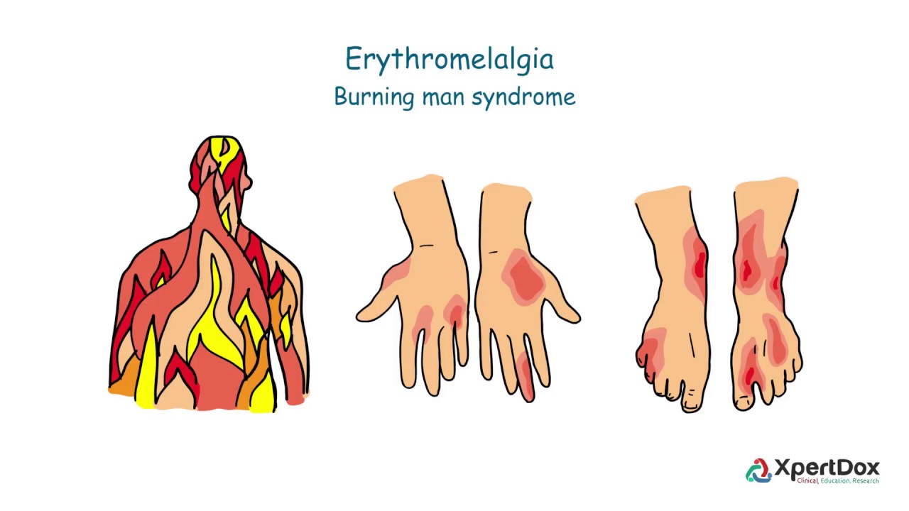 What is Erythromelalgia?