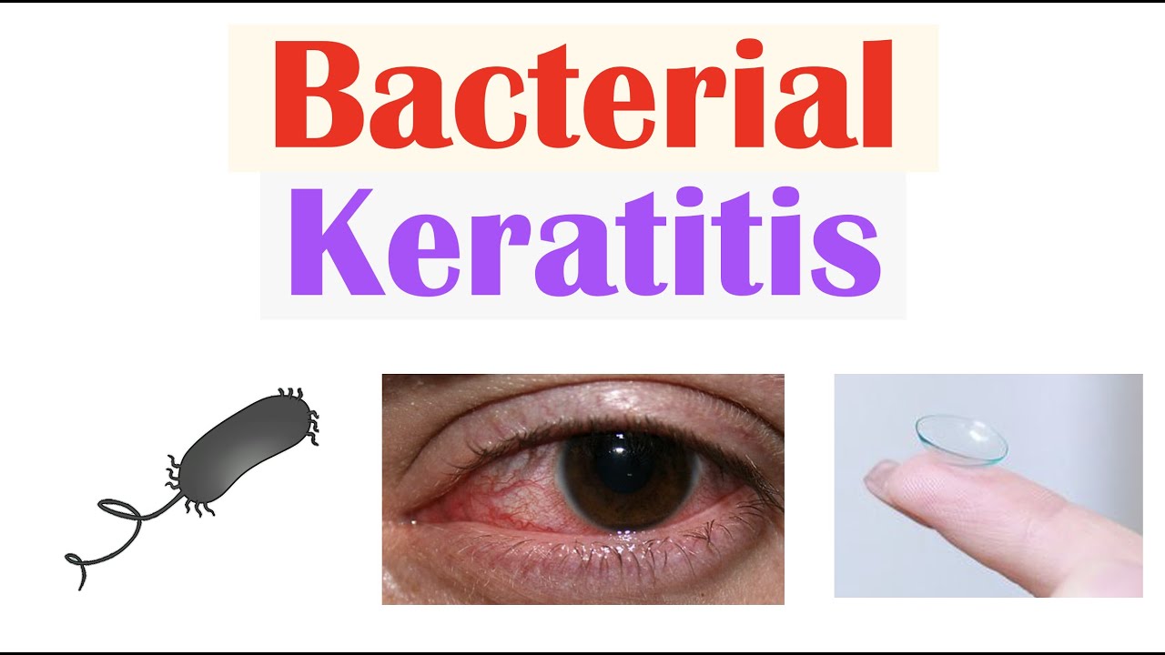 Bacterial Keratitis (Eye Infection From Contact Lenses) | Causes, Symptoms, Diagnosis, Treatment