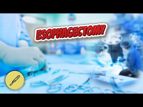 Esophagectomy - Everything Surgeries ✅😬⁉️