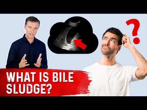 Bile Sludge is a Pre-Gallstone Condition!! – Bile Sludge Treatment Covered by Dr. Berg