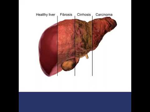 Men's Health Week - Liver Disease