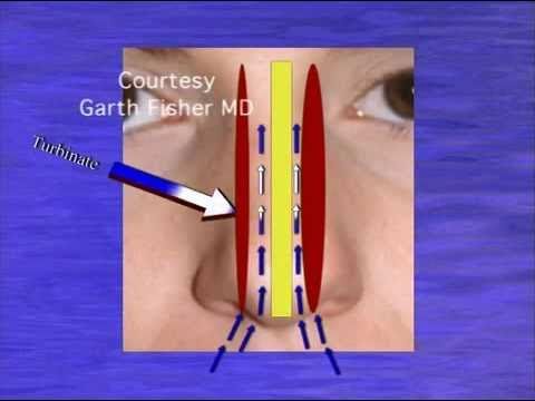 NT Vol. 4 Ch. 5 - What is Rhinoplasty?