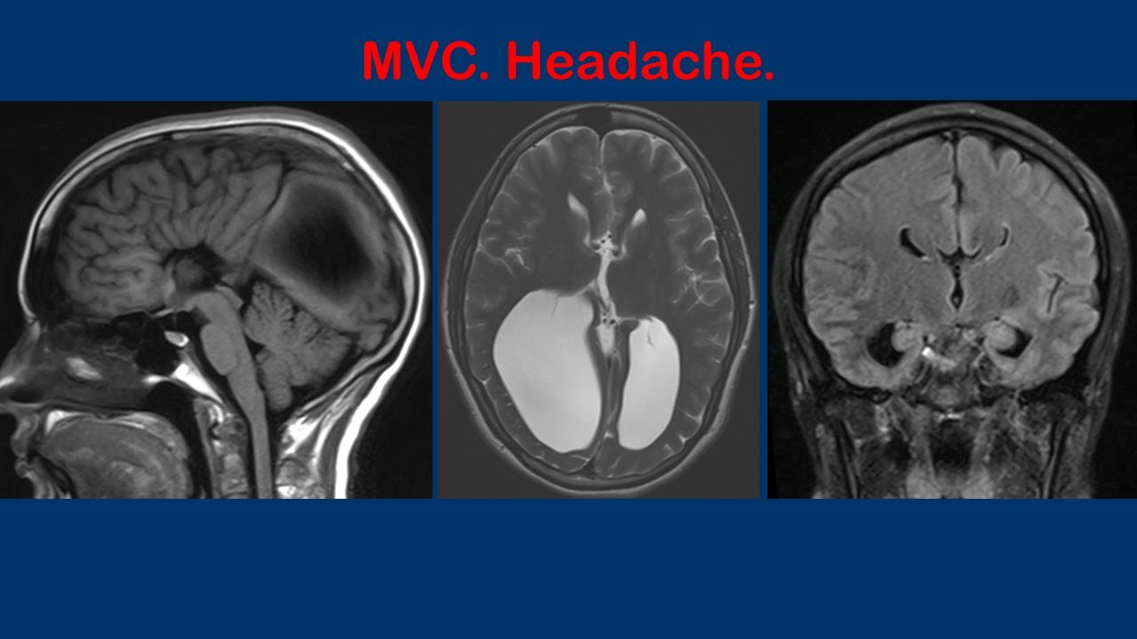 Agenesis of corpus callosum