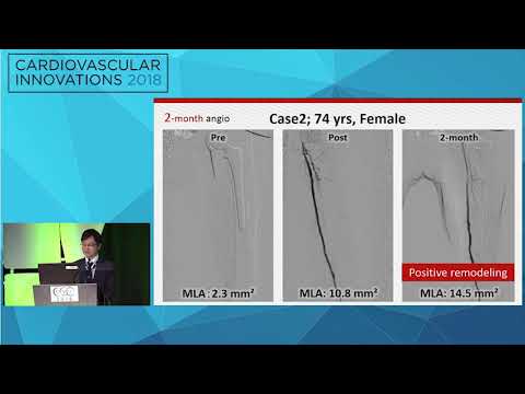 CVI2018 Session: DCB and reimbursement, where should we draw the line? - Osamu Iida, MD