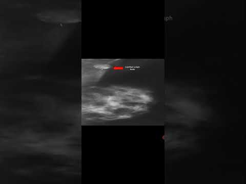 Calcified Axillary Lymph Node of Breast Mammography@#@Breast Cancer@#@Breast disease.Awerenes of All