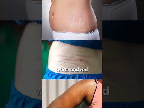 Stretch marks removal cream dermatologist recommended #shorts #viralshorts