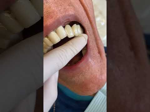 Missing teeth?! Partial denture for healing stage before implants #dentistryworld #shortvideo